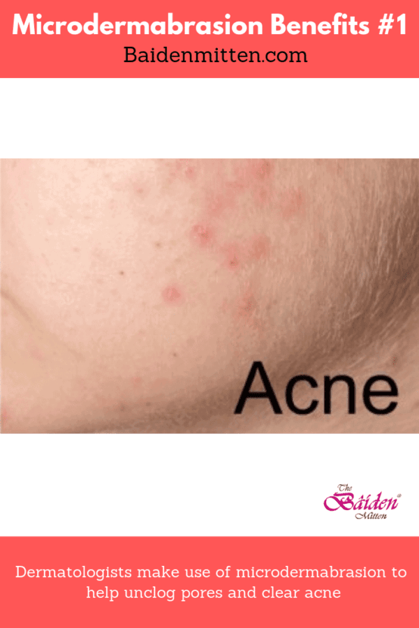 Microdermabrasion Acne Scars – Baiden Mitten